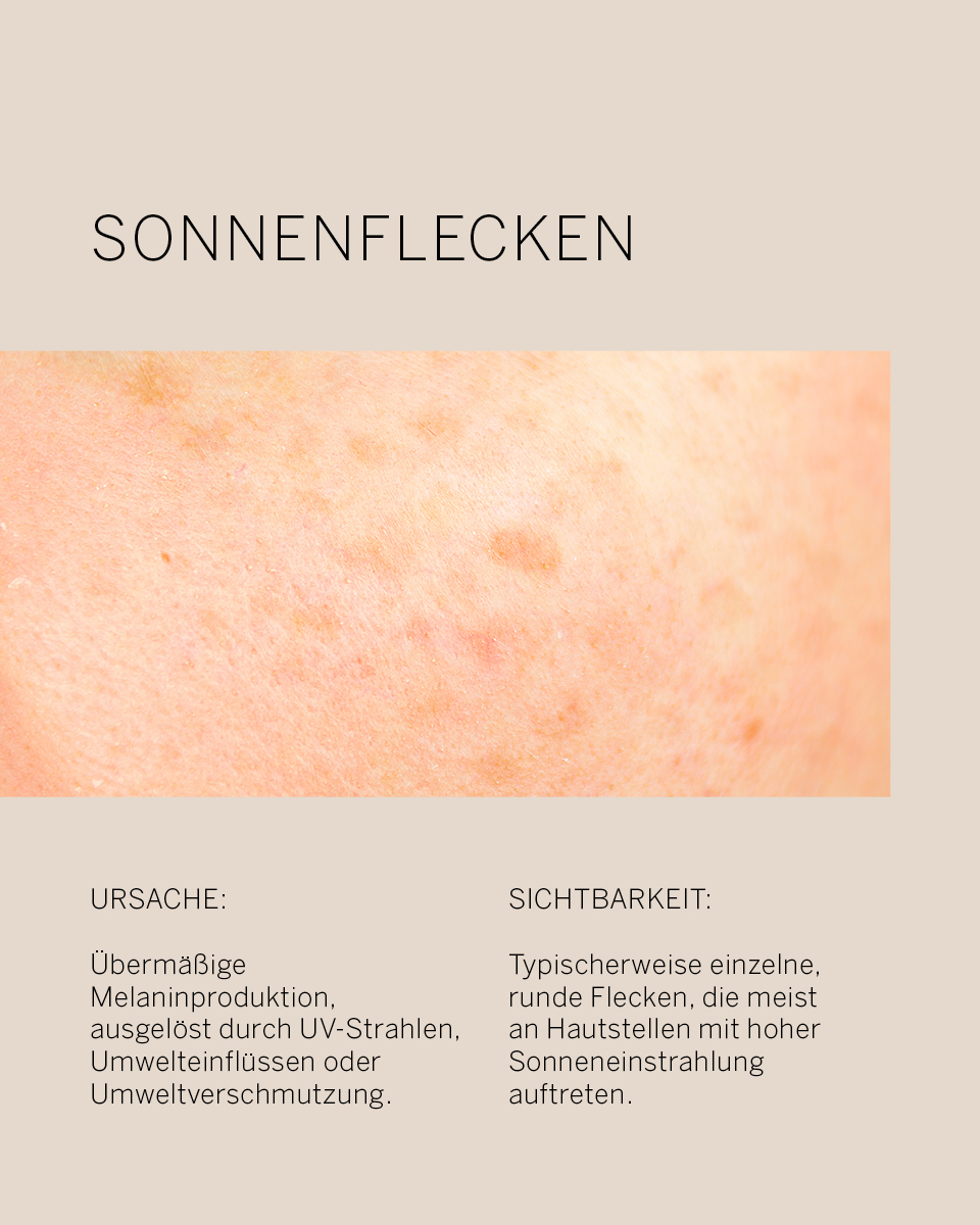Hyperpigmentierung – Alles über Pigmentflecken und wie Du sie loswirst │ mit BABOR