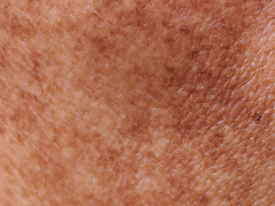 Hyperpigmentierung – Alles über Pigmentflecken und wie Du sie loswirst │ mit BABOR